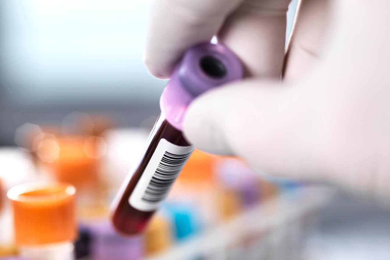 Blood test for Alzheimer's could lead to earlier diagnosis | Fortune Well
